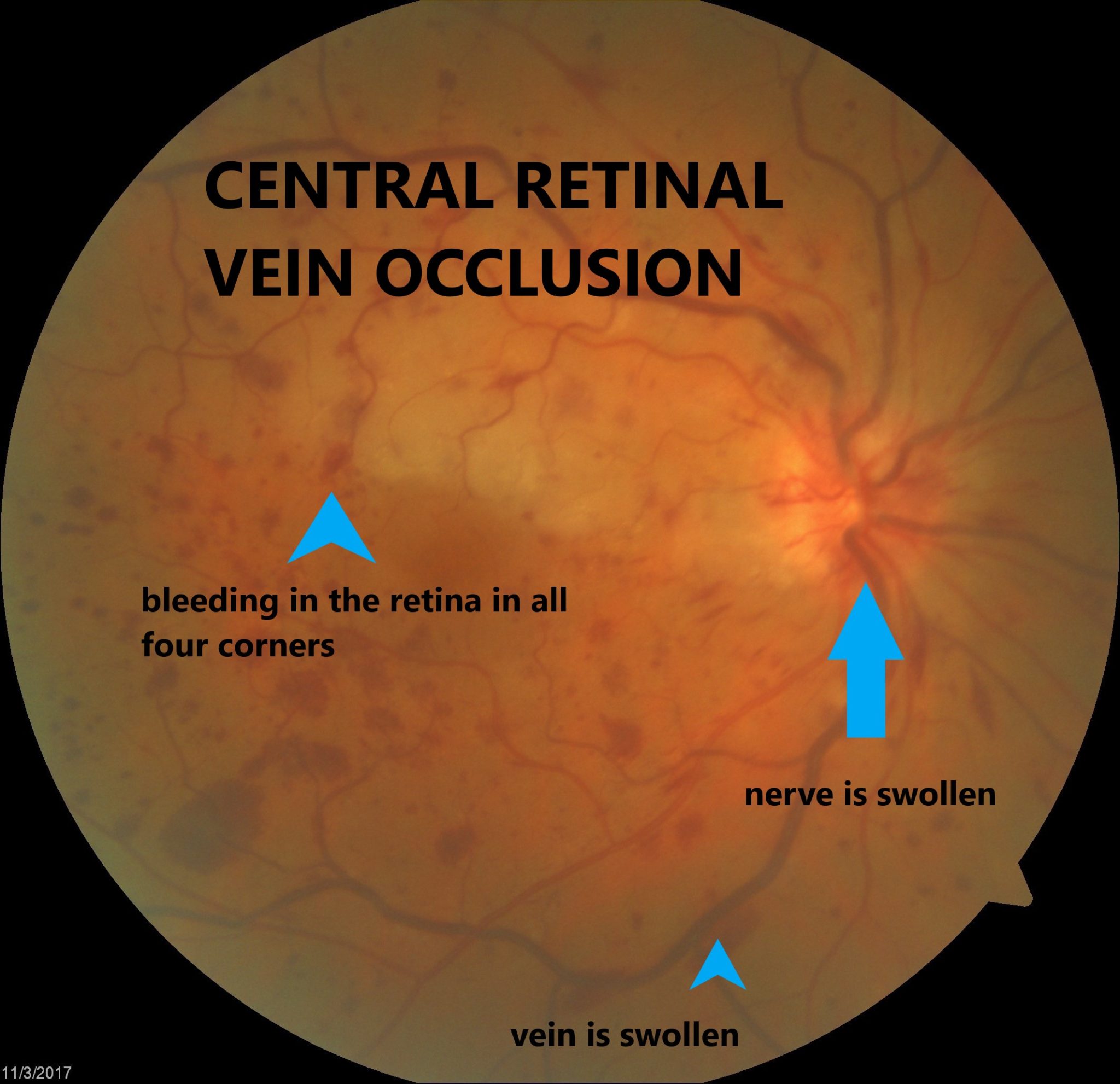 Vein Occlusion: What Is It? | SK Retina Specialist in Sarasota